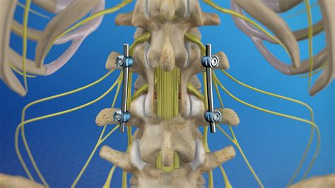 Laminectomy Without Fusion