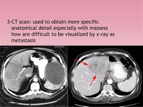 Abdominalmass 140808145556 Phpapp01 3 Ppt