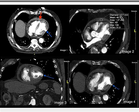 Pdf Post Myocardial Infarction Left Ventricular Aneurysm With Contained Rupture And