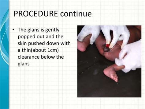 PAUL'S CIRCUMCISION | PPTX | Sexual Health | Diseases and Conditions