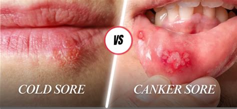 Cold Sore Community Cold Sores Vs Canker Sores Whats The