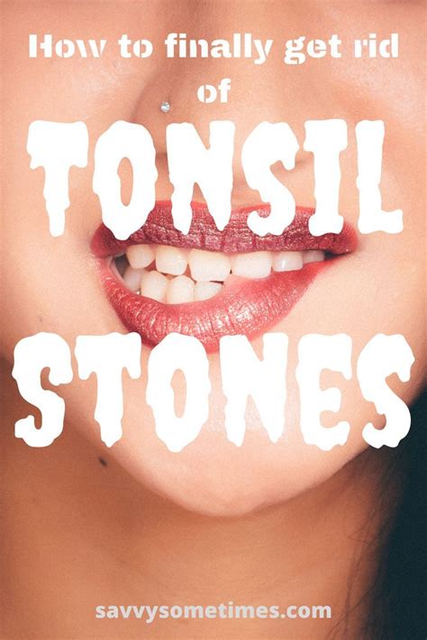 Big Tonsil Stones Hidden In Throat Tips For Removal Artofit