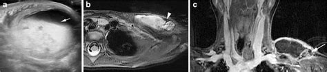 Angiomatoid Fibrous Histiocytoma In A 3 Year Old Girl With A Shoulder