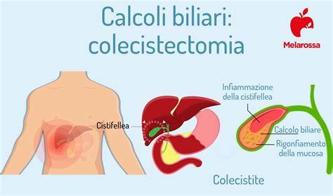 Calcoli Biliari Cosa Sono Sintomi Cause Diagnosi E Cura