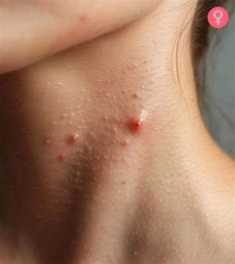 Pimples On Hairline Of Neck Causes Treatments And Skincare Tips