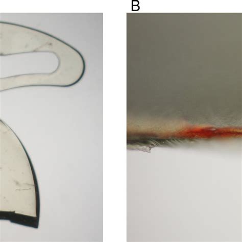 Brain Ct Scan Hyperdensity In Vitreous Cavity Of The Left Eye Download Scientific Diagram