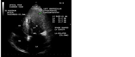 Left Ventricular Apical Mass Paul Smith
