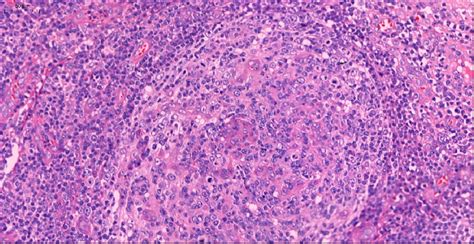 Hyalinized Germinal Center Including Plasmablast Like Cells Hande Stain