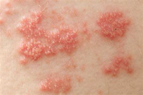 Rash Under The Breast Causes And When To See A Doctor Maladie De