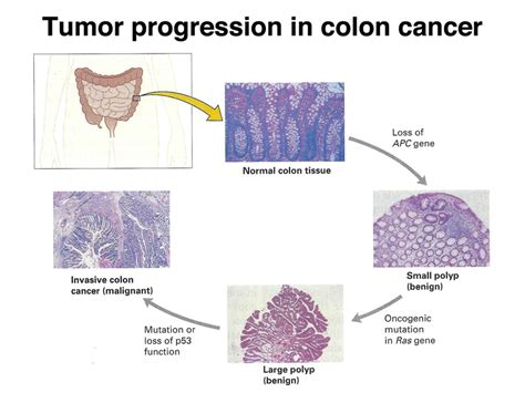 Colorectal Cancer New Evidence About The Predictive Value Of Biomarkers