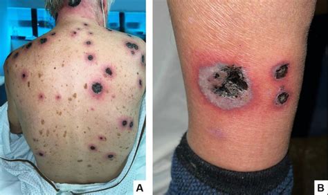Ecthyma Gangrenosum Of Atypical Origin Internal And Emergency