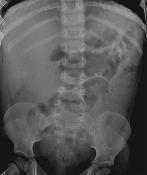 Pediatrics 91 Pediatric Abdomen And Retroperitoneum Case 912