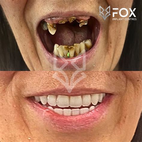 Fox Bone Loss From Missing Teeth And Gum Disease Can Affect Your