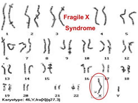 Fragile X Syndrome Karyotype