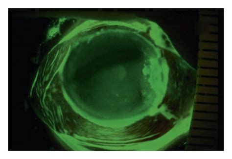 Photographs Of The Fluorescein Stained Positive Epithelial Defect Of