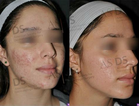 Acne Laser Treatment Before And After My Xxx Hot Girl