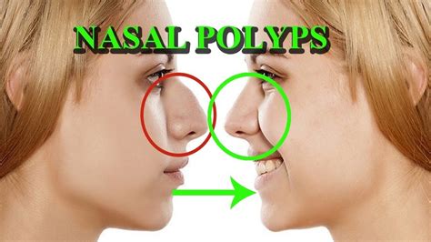 Nasal Polyps Symptoms Causes Treatment By James Denlinger Medium