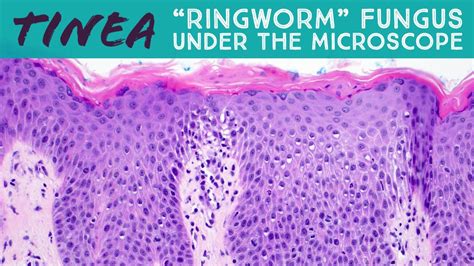 Ringworm Microscope
