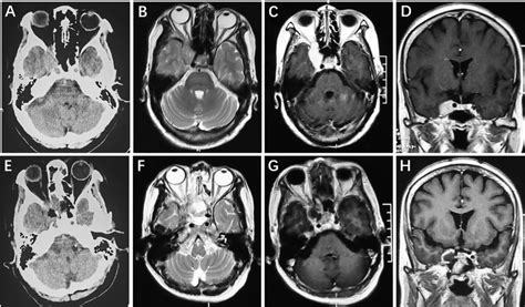 Right Intracavernous Hpc Preoperative Axial Ct Showed A Slightly