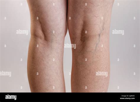 Bilberry For Varicose Veins At Terri Kent Blog