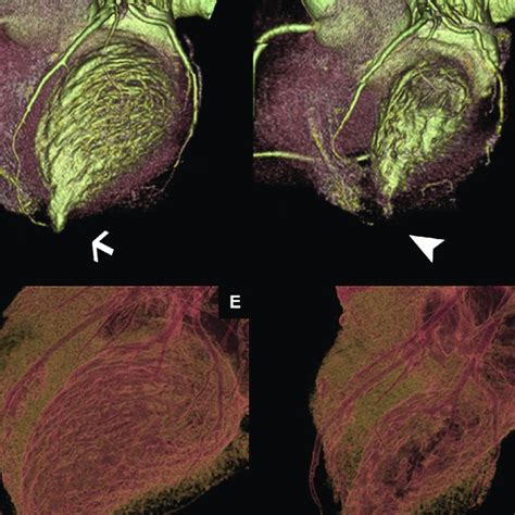 Differential Diagnoses Of Congenital Left Ventricle Diverticulum