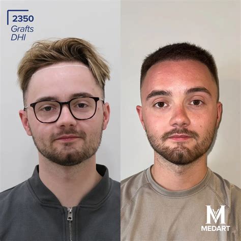 Hair Transplant Turkey Cost 2026 Medart Hair