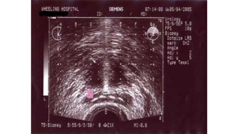 Transverse Ultrasound Image Of The Seminal Vesicles With Four Implanted