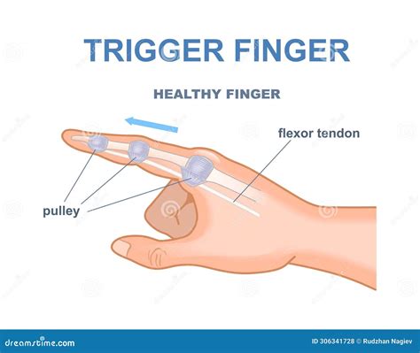 Trigger Finger Diagram Stock Illustration 279741844