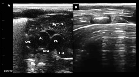 Video A Modified Sonographic Algorithm For Image Acquisition In Life