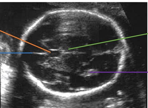 Diagram Of Thalamic View Quizlet