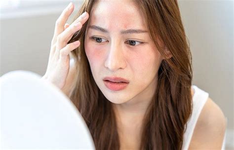Is Lemon Juice Good For Acne And Acne Scars