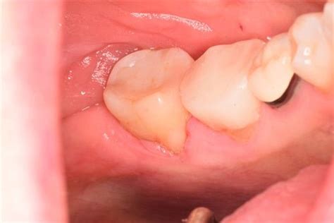 Lingual Root Class V Caries On 18 Greater Curve