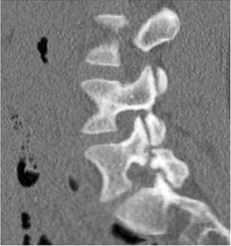 Sagittal Limited Z Axis Ct Scan Optimized To Decrease Radiation Dose Download Scientific