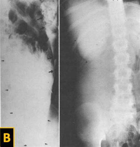 Anatomía Del Retroperitoneo Los Planos Interfasciales Un Cambio De