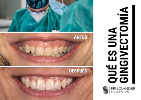 Qué Es La Gingivectomía Y Cómo Se Hace Clínica Friedländer