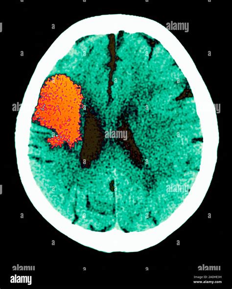 Stroke Coloured Computed Tomography Ct Scan Of A Cerebrovascular Accident Stroke Stroke Is