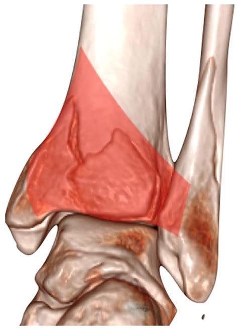 Posterior Tibiofibular Ligament