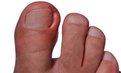 Uñas Encarnadas UPP UPP