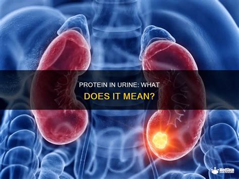 Protein In Urine What Does It Mean Medshun