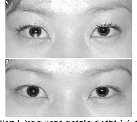 Black Corneal Tattooing
