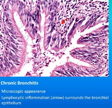Chronic Bronchitis Flashcards Quizlet