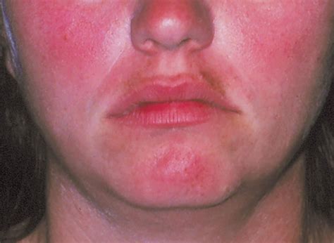 The Best Skin Care Routine For Rosacea Readers Digest Readers Digest