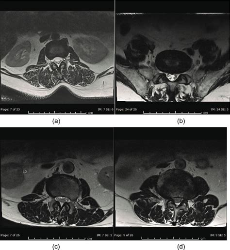 Degrees Of Central Spinal Canal Stenosis A No Stenosis B Mild