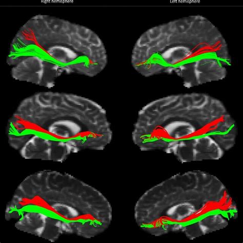 The Top Panel Illustrates The Dorsal And Ventral Tracts Of The Inferior Download Scientific
