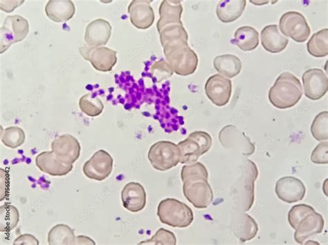 Rare Giant Platelets