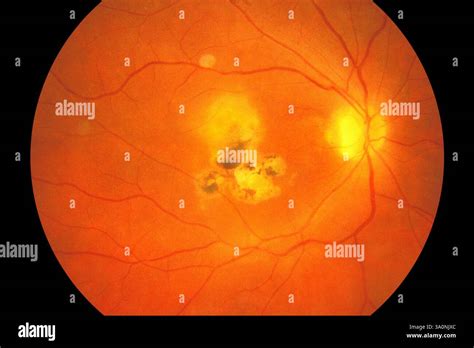Chorioretinitis Fundus Photograph View Of The Interior Surface Of A Human Eye Affected By