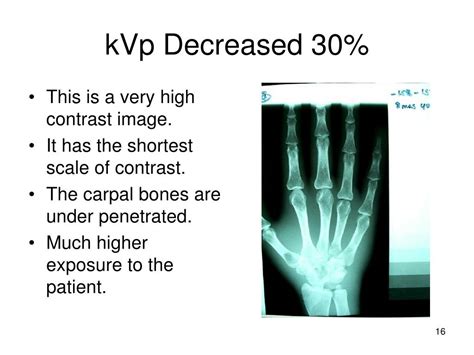 PPT Kilovolt Peak KVp PowerPoint Presentation ID