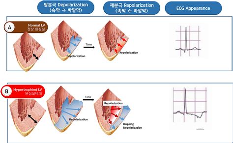 ️ ️stemi 심전도 분석 St분절 상승에 따른 심근경색