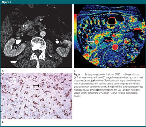 Figure 1 From Pancreatic Endocrine Tumors Tumor Blood Flow Assessed