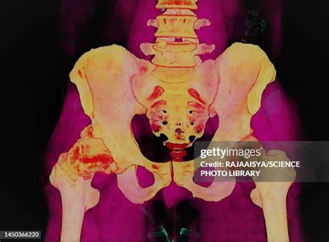 Osteoarthritis X Ray Photos And Premium High Res Pictures Getty Images